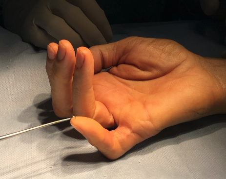 Maladie de Dupuytren - Centre de Chirurgie de la Main