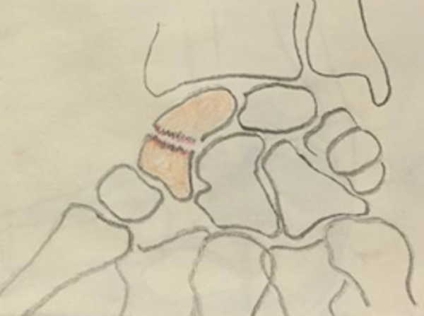 Fracture du scaphoïde - Centre de Chirurgie de la Main