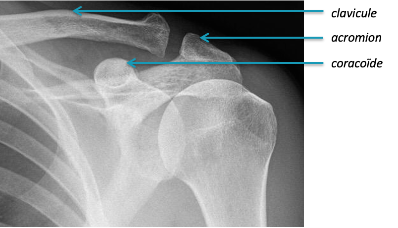 Disjonction Acromio-Claviculaire - Centre de Chirurgie de la Main