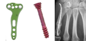 Ablation de Matériel d’ostéosynthèse (AMOS) - Centre de Chirurgie de la ...