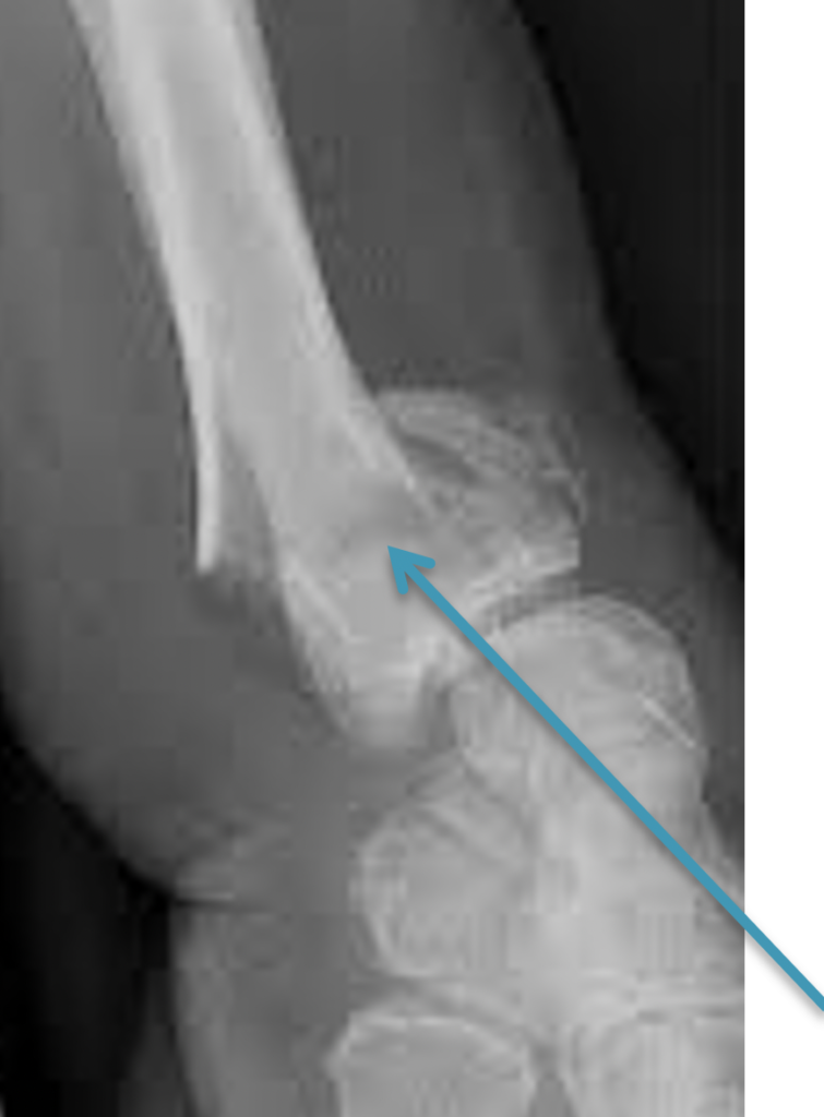 Fracture du poignet chez l’adulte - Centre de Chirurgie de la Main