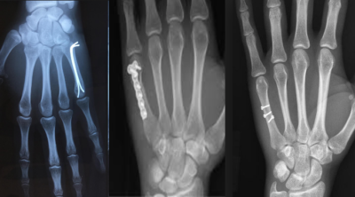 Fracture du 5e métacarpien - Centre de Chirurgie de la Main