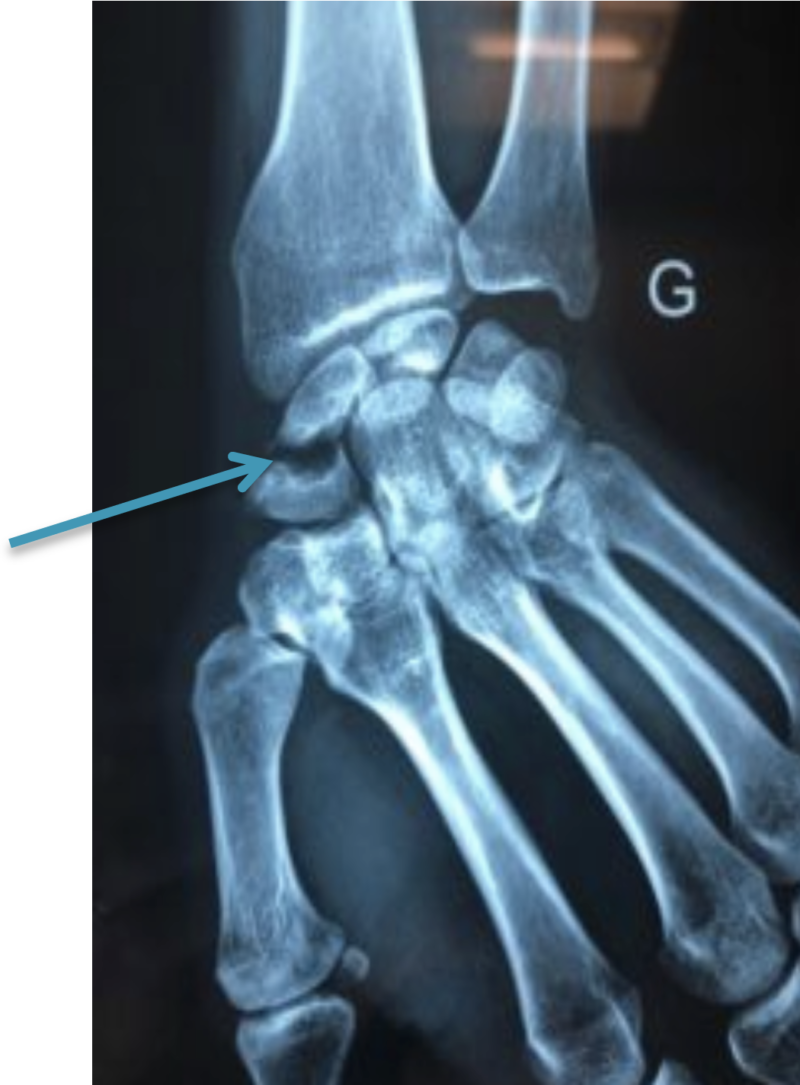 Fracture du scaphoïde - Centre de Chirurgie de la Main